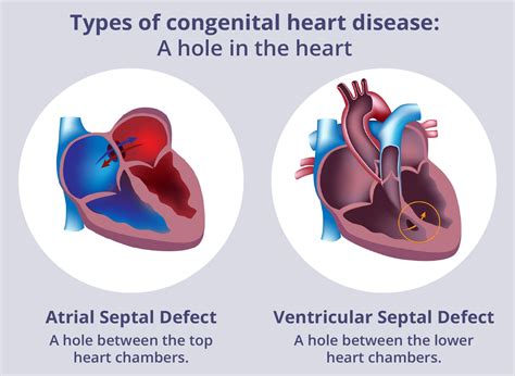 Congenital Heart Disease Types Symptoms And Diagnosis Pregnancy