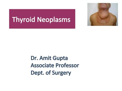 Thyroid Neoplasms Ppt Surgery Thyroid Carcinoma Ppt