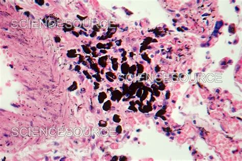 Anthracosis