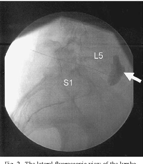 Figure 1 From A New Technique For Superior Hypogastric Plexus Block