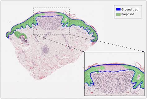Example Slide Where The Model Were Unable To Segment Whole Epidermis
