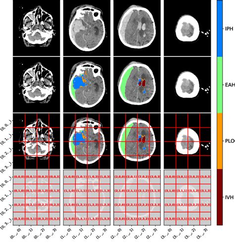 Figure 1 From Automatic Lesion Analysis For Increased Efficiency In Outcome Prediction Of