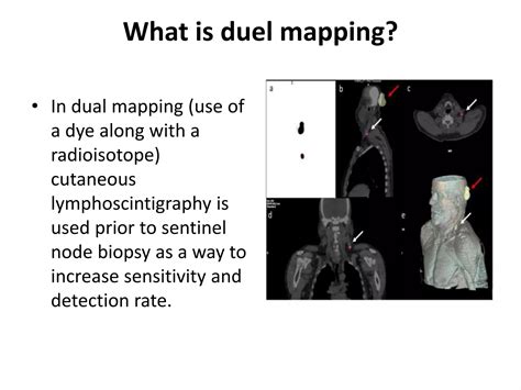 Sentinal Lymph Node Biopsy Pptx