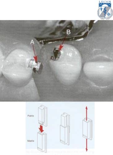 3 Direct And Indirect Retainers Flashcards Quizlet