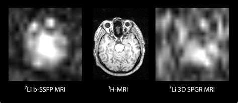 Comparison Of The 7 Li Bssfp Mri And 7 Li Spgr Mri In A Single Subject Download Scientific
