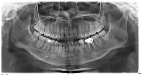 how to use the decting oral lesions object detection api