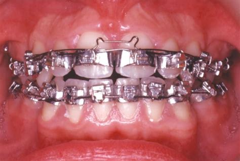 What Braces Looked Like In The 80s At John Verran Blog
