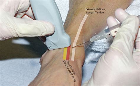 Deep Peroneal Nerve Block Sonoguide