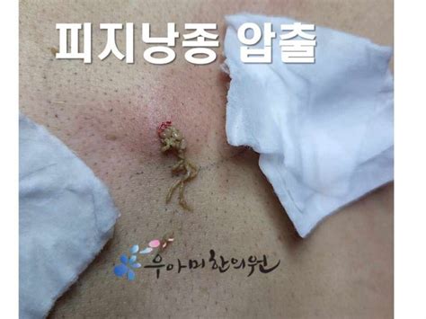 회음부 뾰루지 생식기 종기 연고 고약으로 악화되는 이유 네이버 블로그