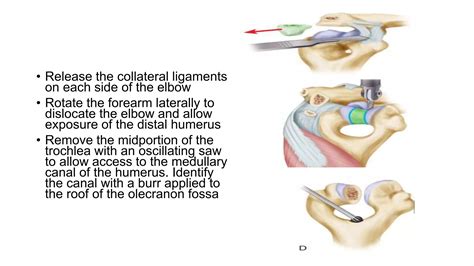 Total Elbow Arthroplasty Pptx