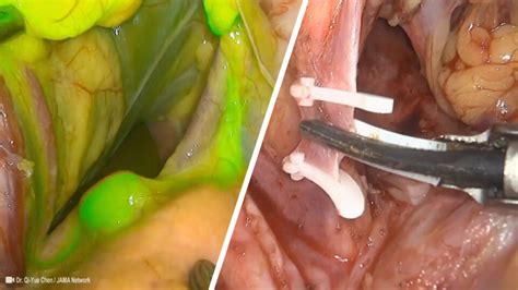 Sentinel Lymph Node Mapping Indocyanine Green Icg Usage In Surgery And Oncology Gynecoloncol