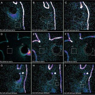 A Year Old Patient Undergoing A Sentinel Node Procedure For Breast Download Scientific