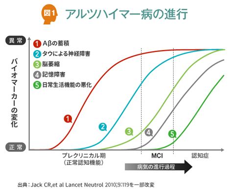 アルツハイマー病は発症の25年前から静かに進行する｜男の健康｜ダイヤモンド・オンライン