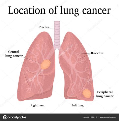 Two Types Of Lung Cancer My XXX Hot Girl