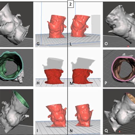 3d Printing Pipeline Cmr Panel 1 And Cct Panel 2 Segmentation