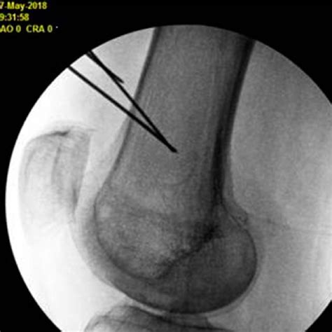 Genicular Nerve Rfa Probe Targets On Anterior Posterior Fluoroscopic Download Scientific
