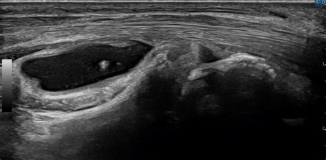 Cppd Massive Tenosynovitis Sonotool®
