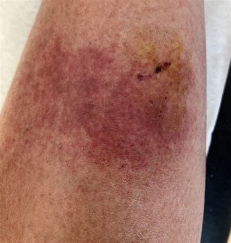 Jeukende En Prikkende Rode Plekken Op Het Scheenbeen Handw