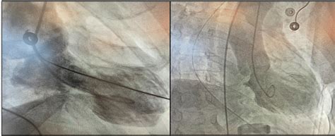 Left Cardiac Catheterization Showed Hyperkinesia Of Base Hypokinesia Download Scientific Left Cardiac Catheterization Showed Hyperkinesia Of Base Hypokinesia Download Scientific