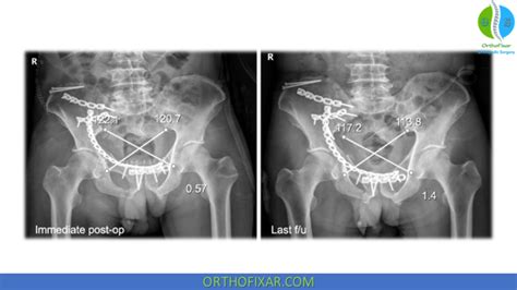 Sacroiliac Joint Dislocation Full Review Orthofixar 2026