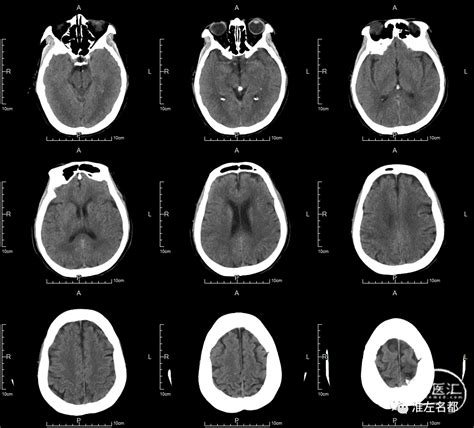 脑血管影像案例（37）：原发性血小板增多症同时并发脑动脉和脑静脉等多系统血栓事件 脑医汇