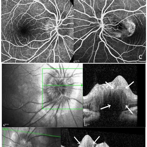 Multi Modal Image Data Of Case 2 A Color Fundus Photography Showed Download Scientific