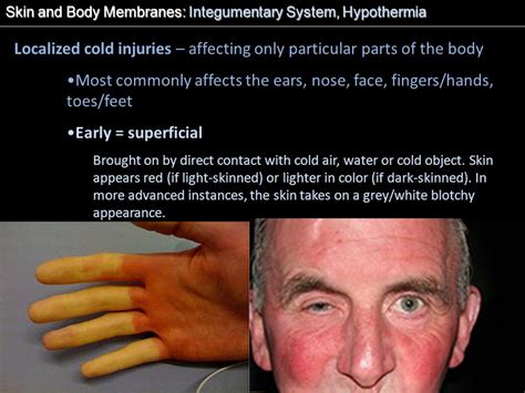 Hyperthermia Skin Color