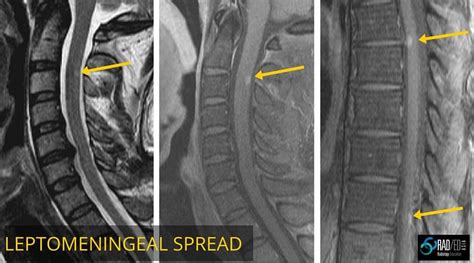 Mri Spinal Cord Compression When To Give Contrast Updated 2021