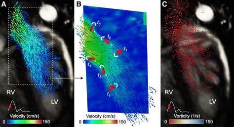 Velocity And Vorticity Vector Fields In The Left Ventricle Lv During