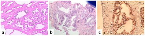 Cribriform Patterned Lesions In The Prostate Gland With Emphasis On