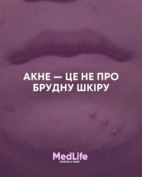 Акне — хронічне захворювання шкіри