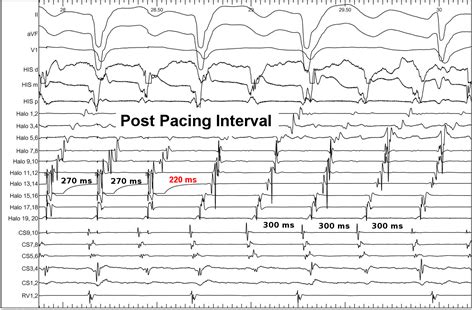 Mapping Fundamentals Electrograms And Entrainment
