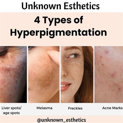 Unknown Esthetics On Instagram Check Out This Informative Post On The