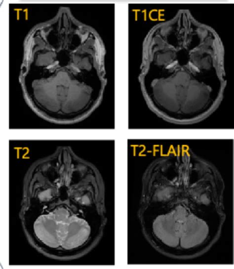 논문 리뷰 3d Graph Attention Networks For High Fidelity Pediatric Glioma