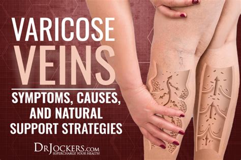Varicose Veins Symptoms Causes And Natural Support Strategies