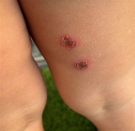 Bullous Impetigo Everything You Need To Know
