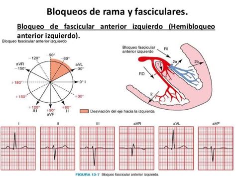 Bloqueos De Rama Y Fasciculares