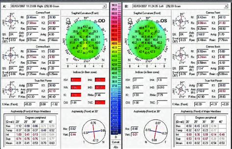 Topometric Map From Both Eyes Once More Od Shows Keratoconus Pattern