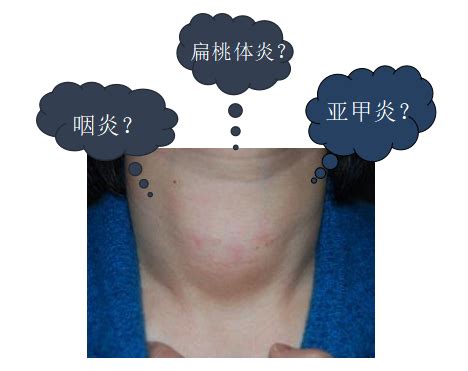 喉咙痛一定是扁桃体炎吗还可能是亚急性甲状腺炎