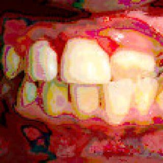 Excision Of Lesion Done Download Scientific Diagram