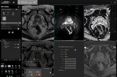 Mr Prostate Ai Based Segmentation And Classification