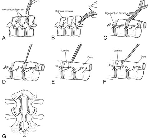 Lumbar Laminectomy Musculoskeletal Key