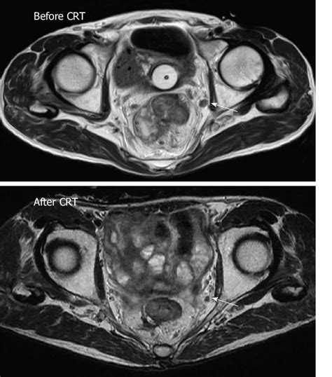 T2 Weighted Axial Image Of Lateral Pelvic Lymph Nodes A 71 Year Old Download Scientific
