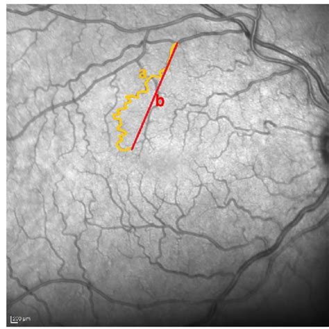 Pdf Retinal Hyperreflective Foci In Fabry Disease