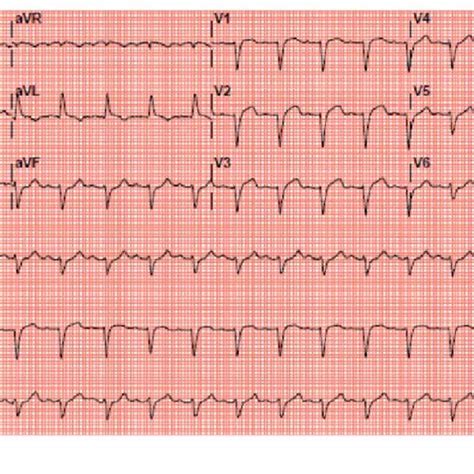 Ecg Showing Sinus Rhythm With Left Bundle Branch Block Download Scientific Diagram
