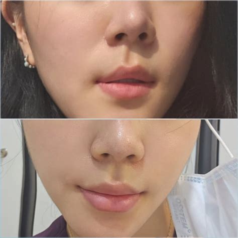 강남역 피부과 쥬베룩 볼륨 2cc 1차 꺼진 팔자에 맞고온 후기팔자 쥬베룩 효과 네이버 블로그