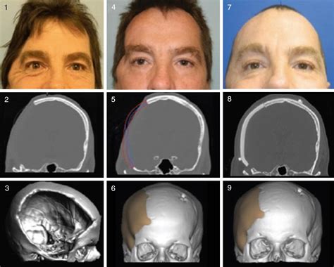 Principles Of Neuroplastic Surgery Management Of Scalp Defects And