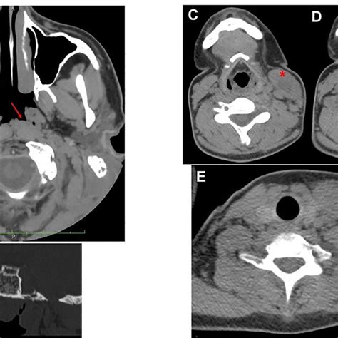 Ear CT Scan A Axial View The Red Circle Shows The Middle Ear Filled Download Scientific