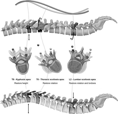 Surgical Technique The Apex Of The Scoliotic Curve And The Apex Of The Download Scientific