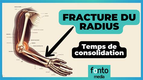 Sport Apres Fracture Du Radius At Laurence Drake Blog